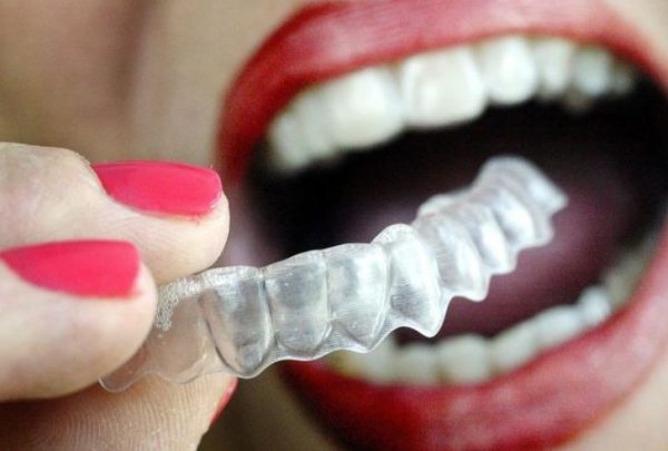 Best at home clear aligner system – Even28: Dentist Search Engine