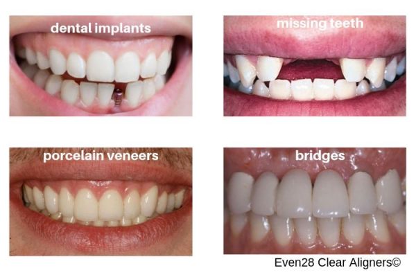 7 Questions to help you decide if at-home clear aligners are right for ...